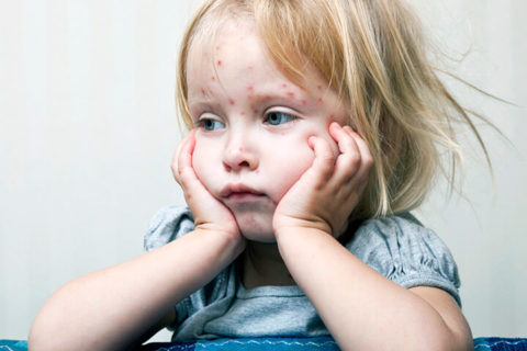 Broj obolelih od morbila u Beogradu postepeno opada - www.lobi-info.rs